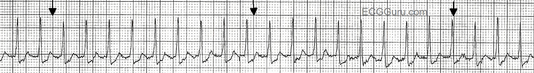 ECG Basics: Supraventricular Tachycardia | ECG Guru - Instructor Resources ECG Basics: Supraventricular Tachycardia | ECG Guru - Instructor Resources